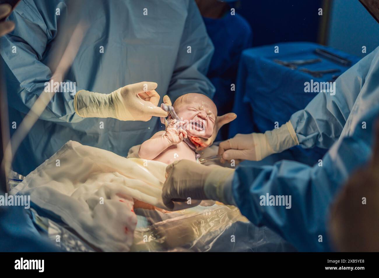 The umbilical cord is visible around the neck of a newborn undergoing ...