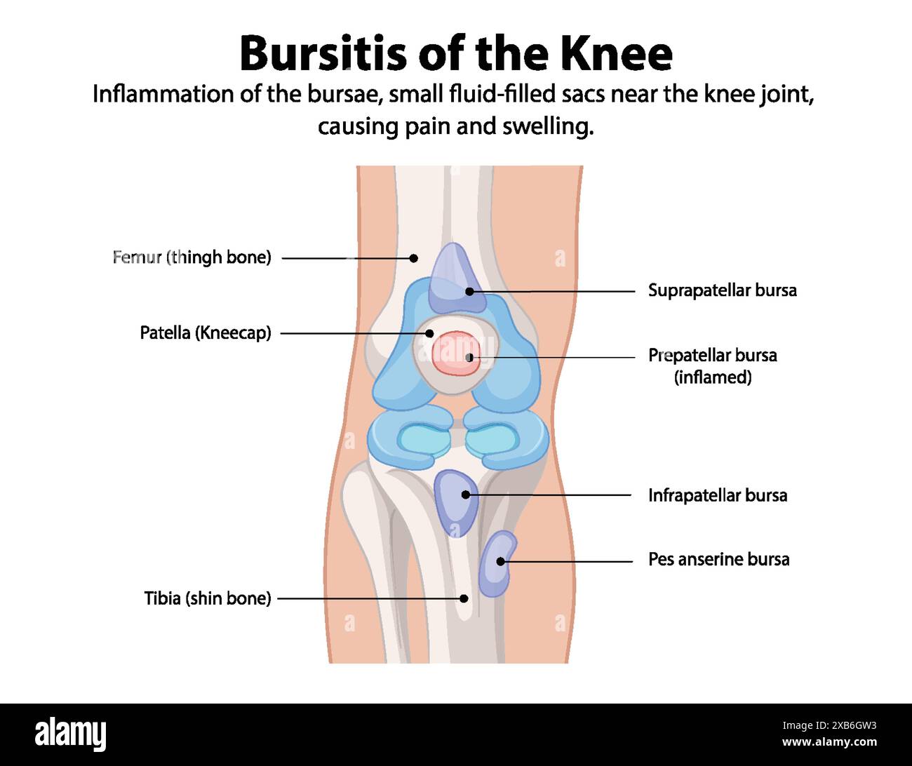 Inflammation of knee bursae causing pain and swelling Stock Vector ...
