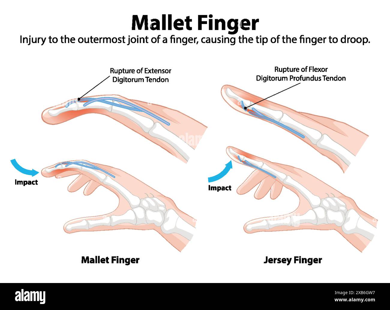 Flexor digitorum profundus tendon Stock Vector Images - Alamy