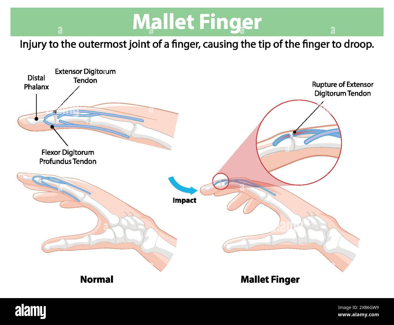 Depicts normal and mallet finger conditions Stock Vector Image & Art ...