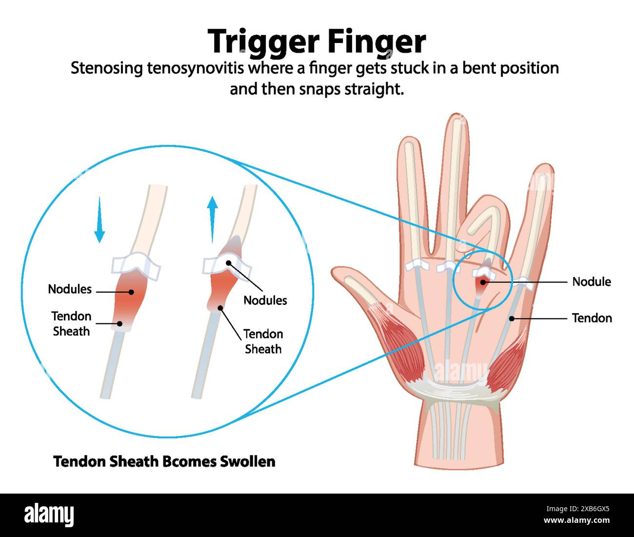 Detailed Depiction Of Trigger Finger Condition Stock Vector Image And Art