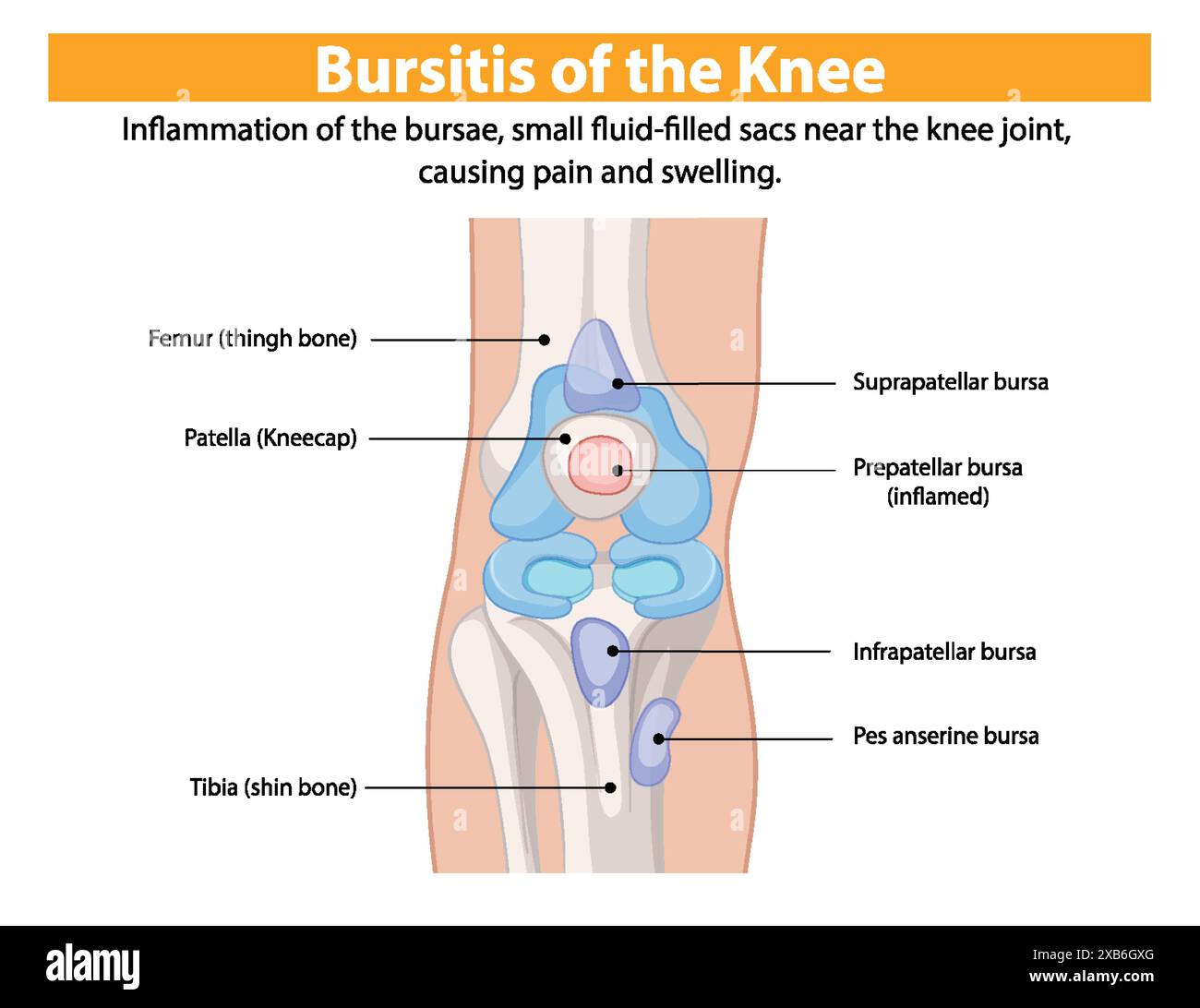 Inflammation of knee bursae causing pain and swelling Stock Vector ...