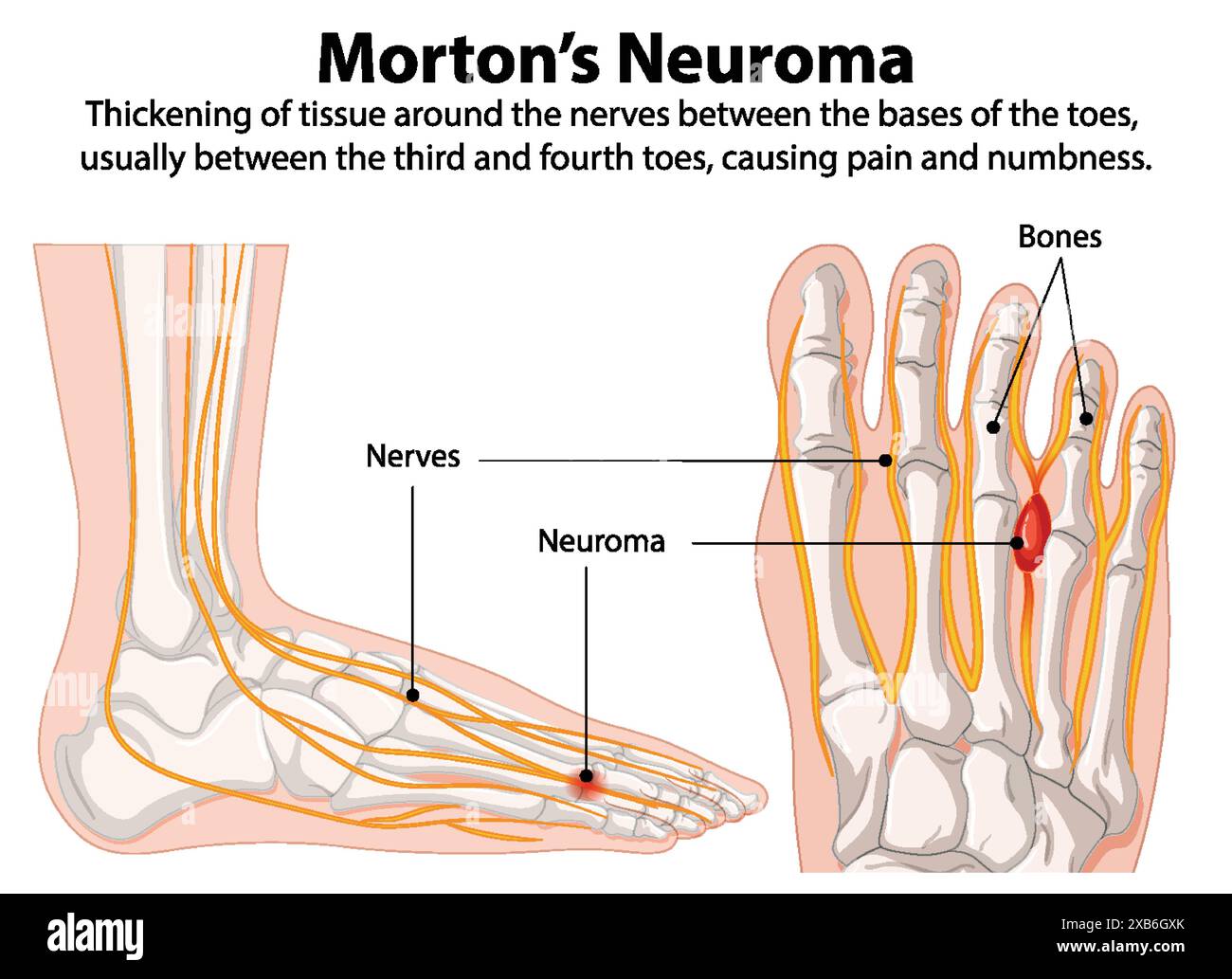 Diagram showing nerve thickening in the foot Stock Vector Image & Art ...