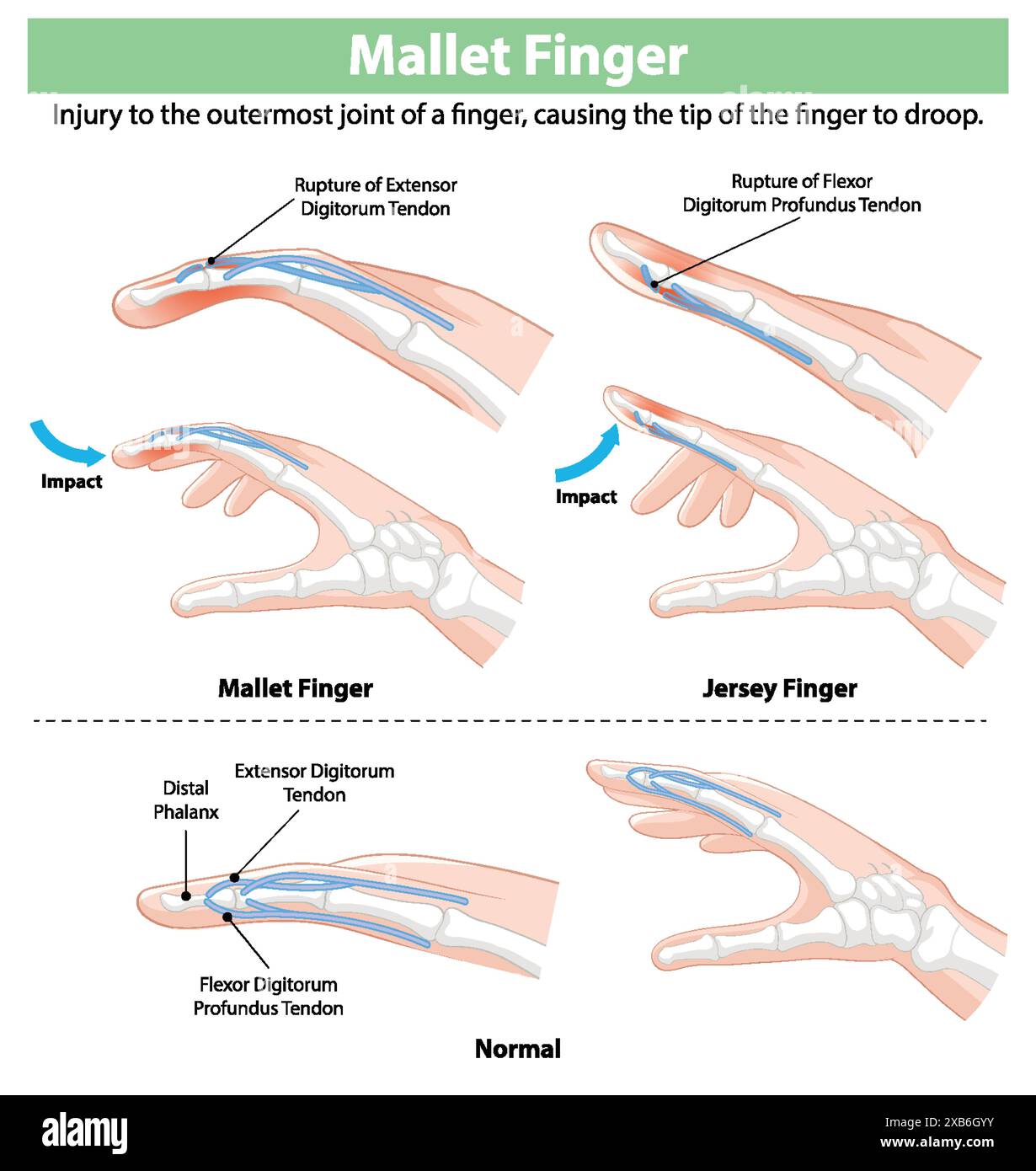 Mallet Finger Diagram at Clyde Patterson blog
