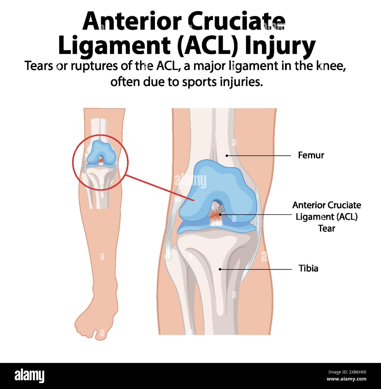 Illustration Of Acl Tear In The Knee Stock Vector Image And Art Alamy 6318