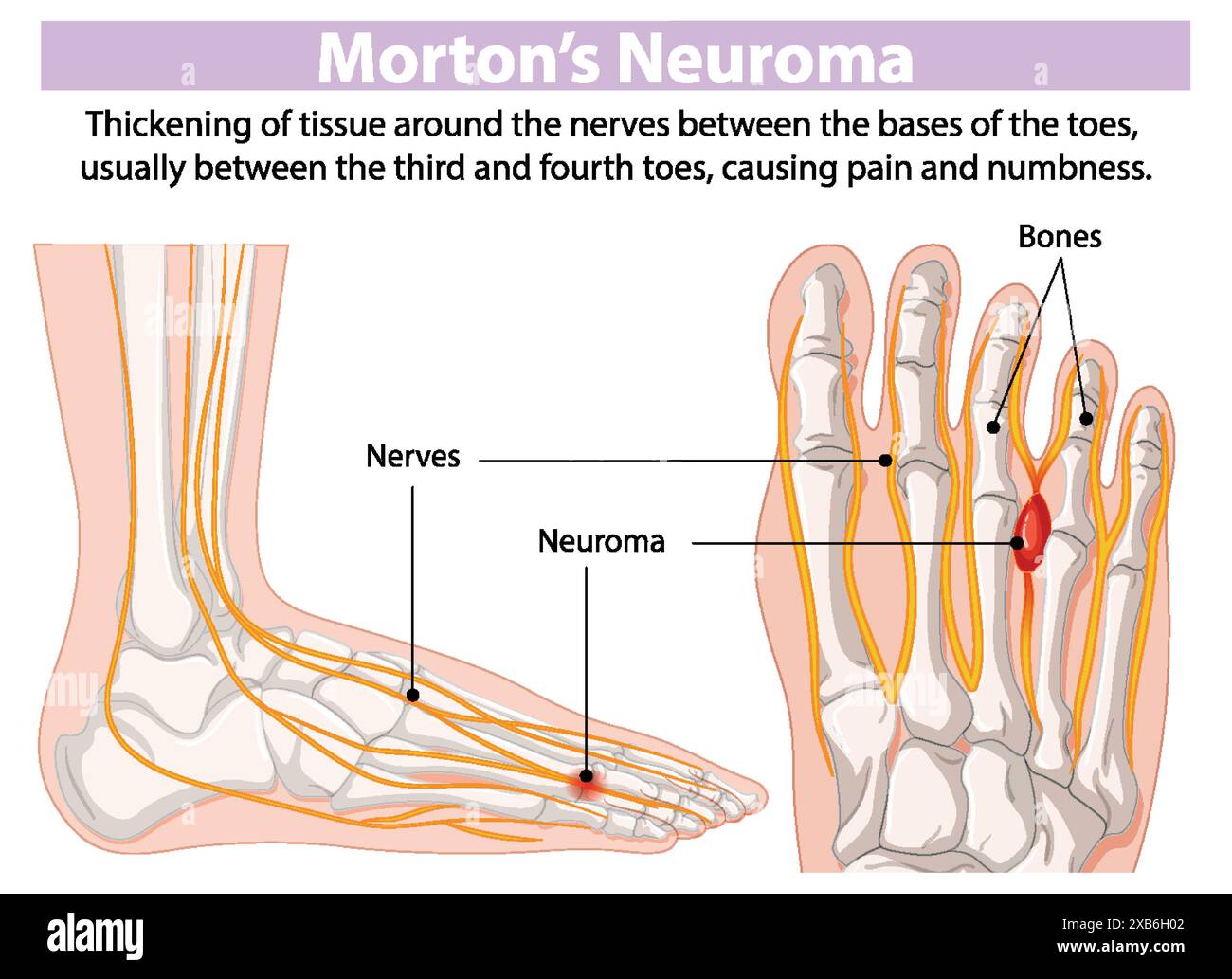 Diagram showing nerve thickening in the foot Stock Vector Image & Art ...