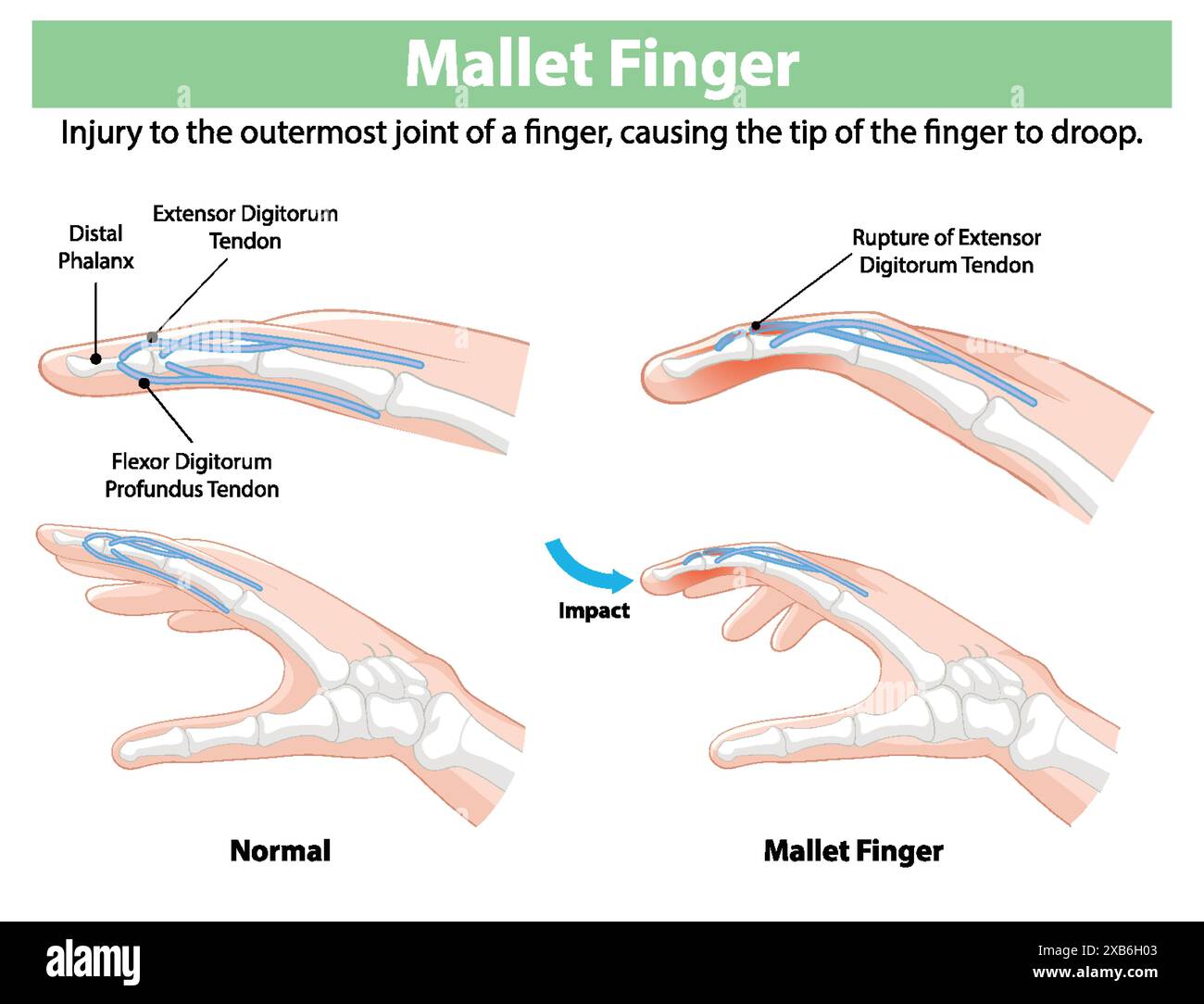 Diagram showing normal and mallet finger conditions Stock Vector Image & Art - Alamy