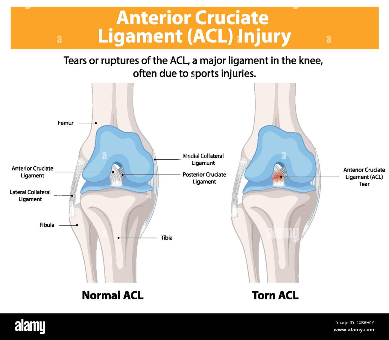Comparison of normal and torn ACL in the knee Stock Vector Image & Art ...