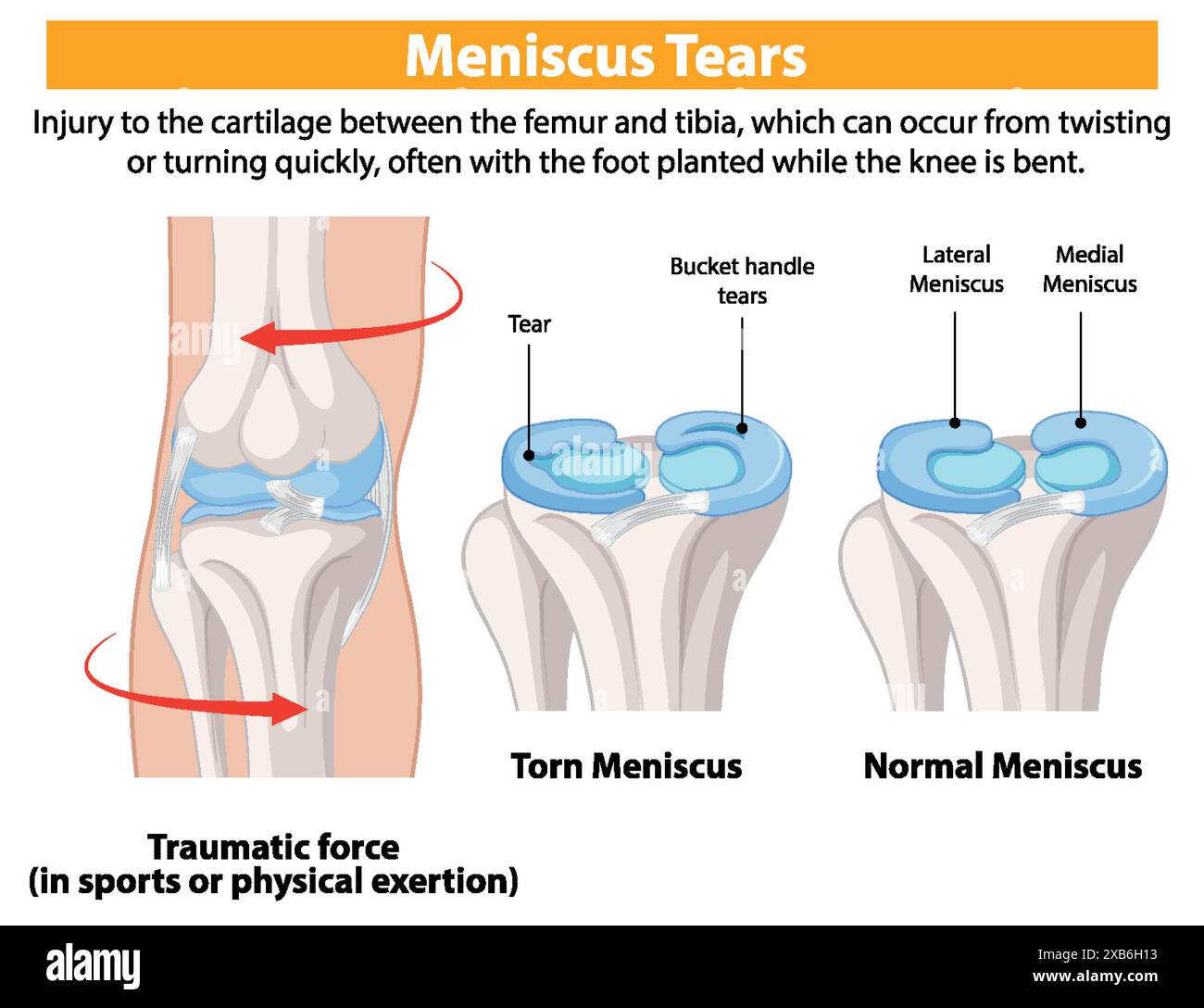 Illustration of normal and torn meniscus in knees Stock Vector Image ...