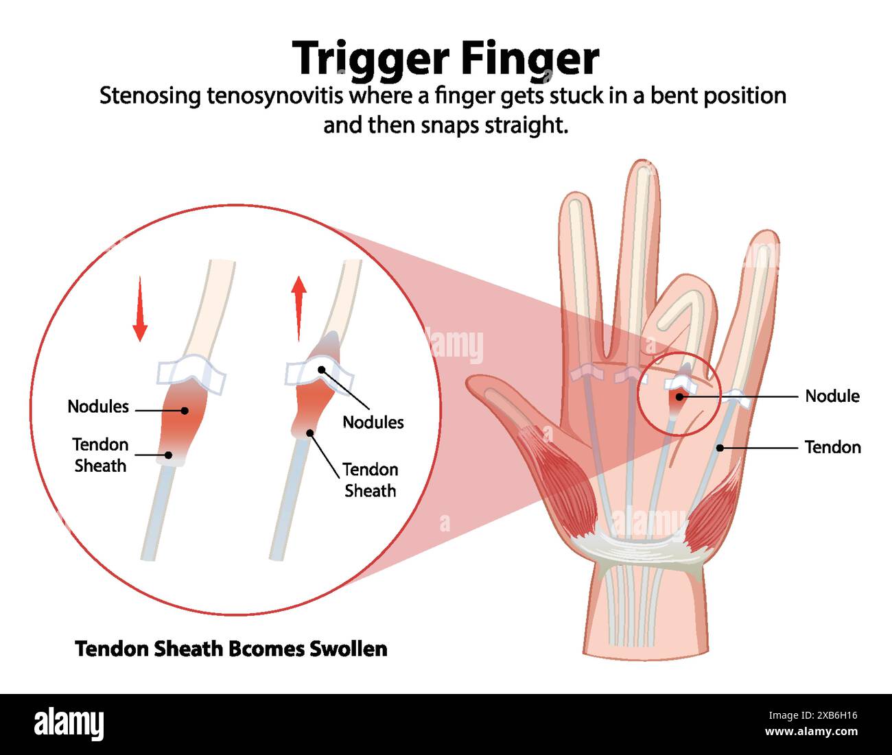 Detailed Depiction Of Trigger Finger Condition Stock Vector Image And Art