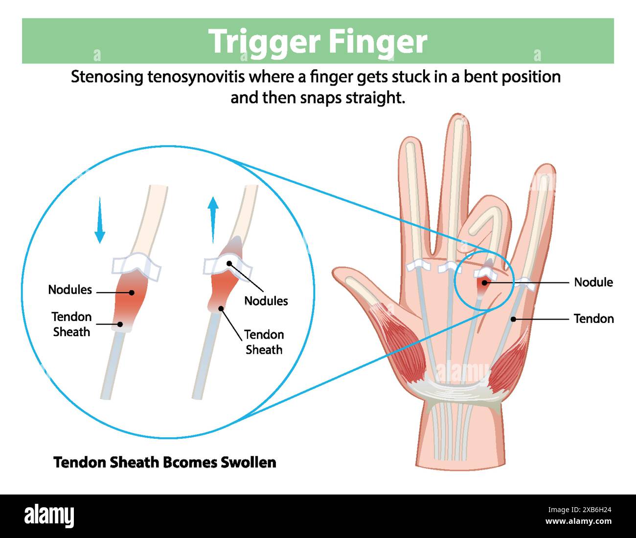 Diagram Explaining Trigger Finger Condition Stock Vector Image And Art