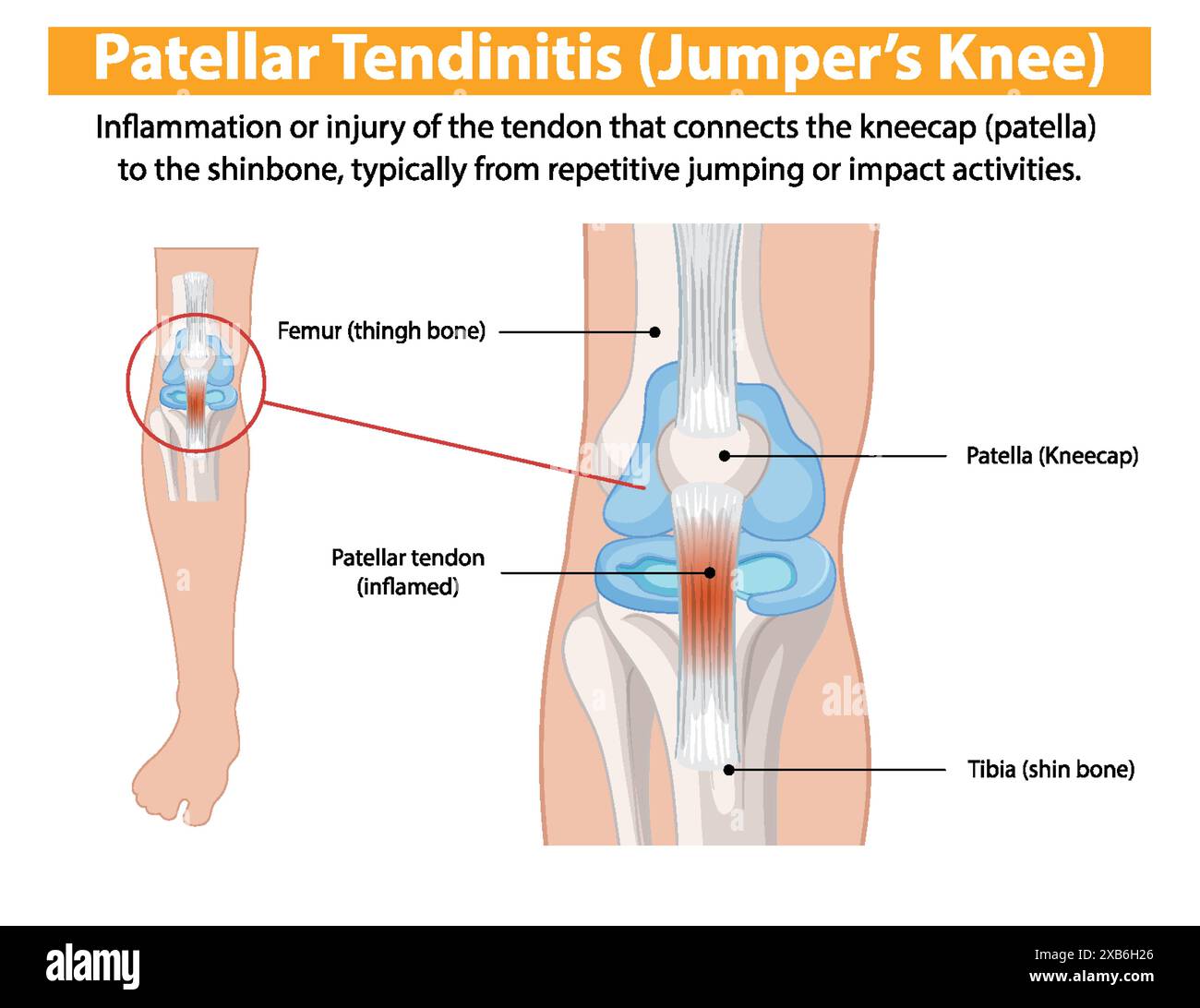 Inflammation of the patellar tendon from repetitive jumping Stock ...