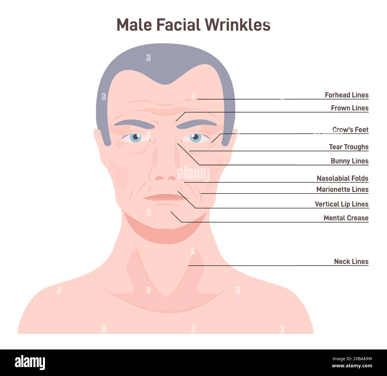 Mimic wrinkles. Age-related skin changes. Aging process, forehead ...
