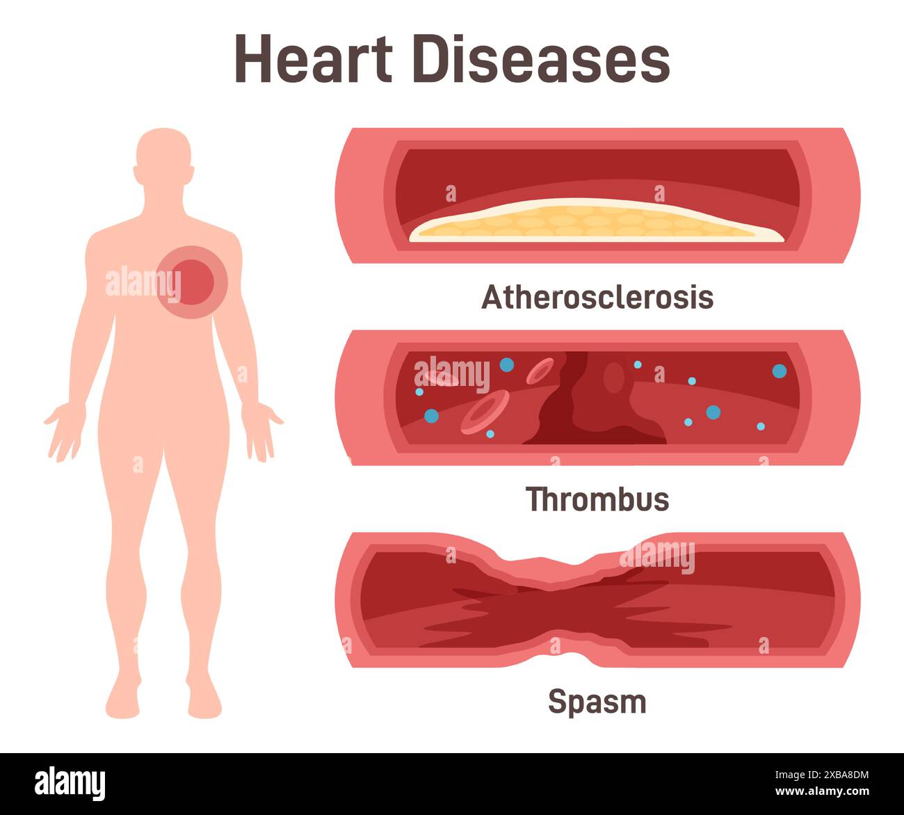 Heart diseases. Atherosclerosis, thrombus, coronary artery spasm ...