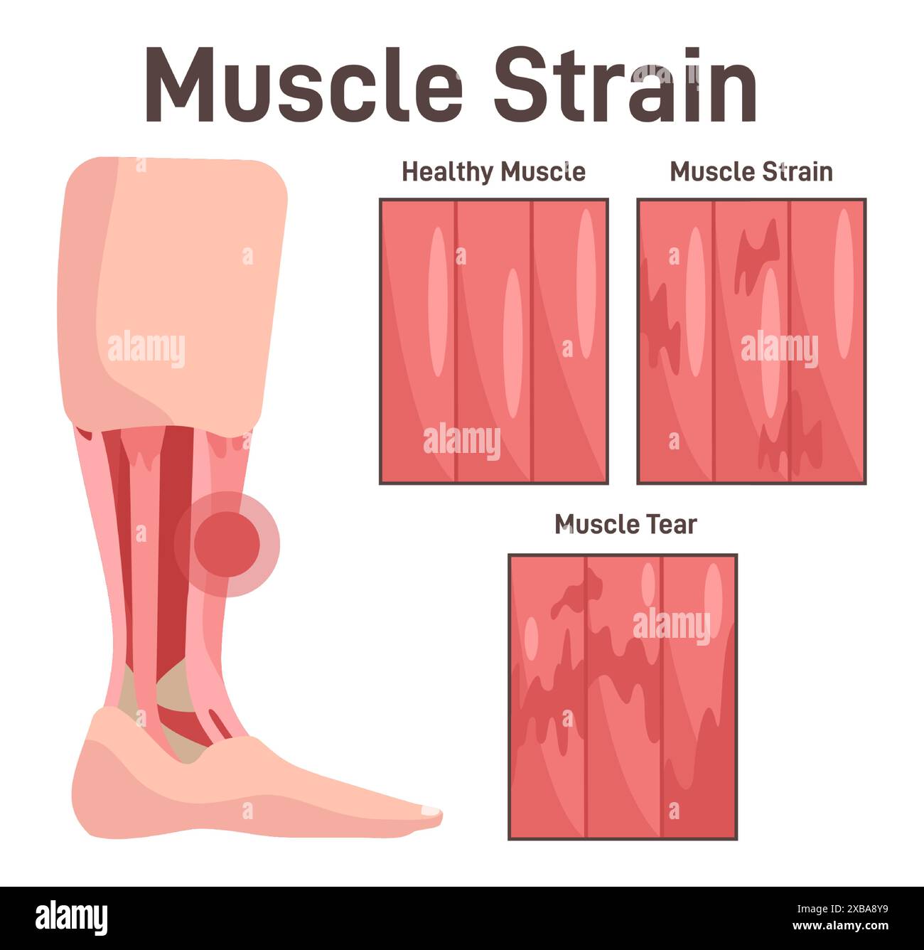 Leg muscle injury. Muscle strain at different stages, healthy, strained ...