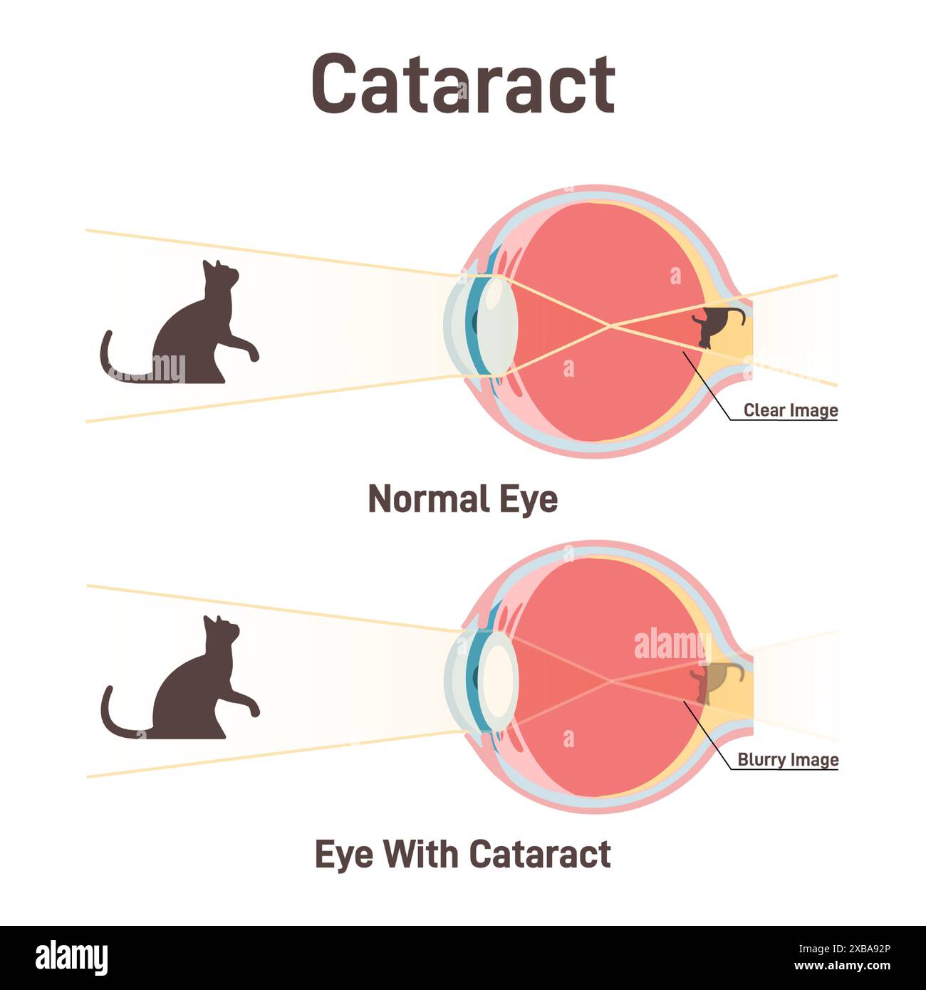 Cataract. Clouding of the lens, decrease of vision. Anatomical cross ...