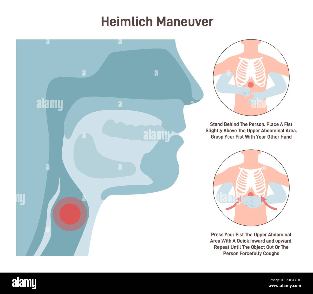 Choking first aid. Heimlich maneuver procedure to remove a foreign ...