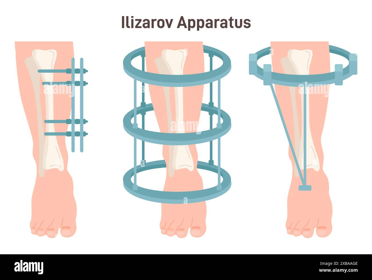 The Ilizarov apparatus set. External ring fixation technique in ...
