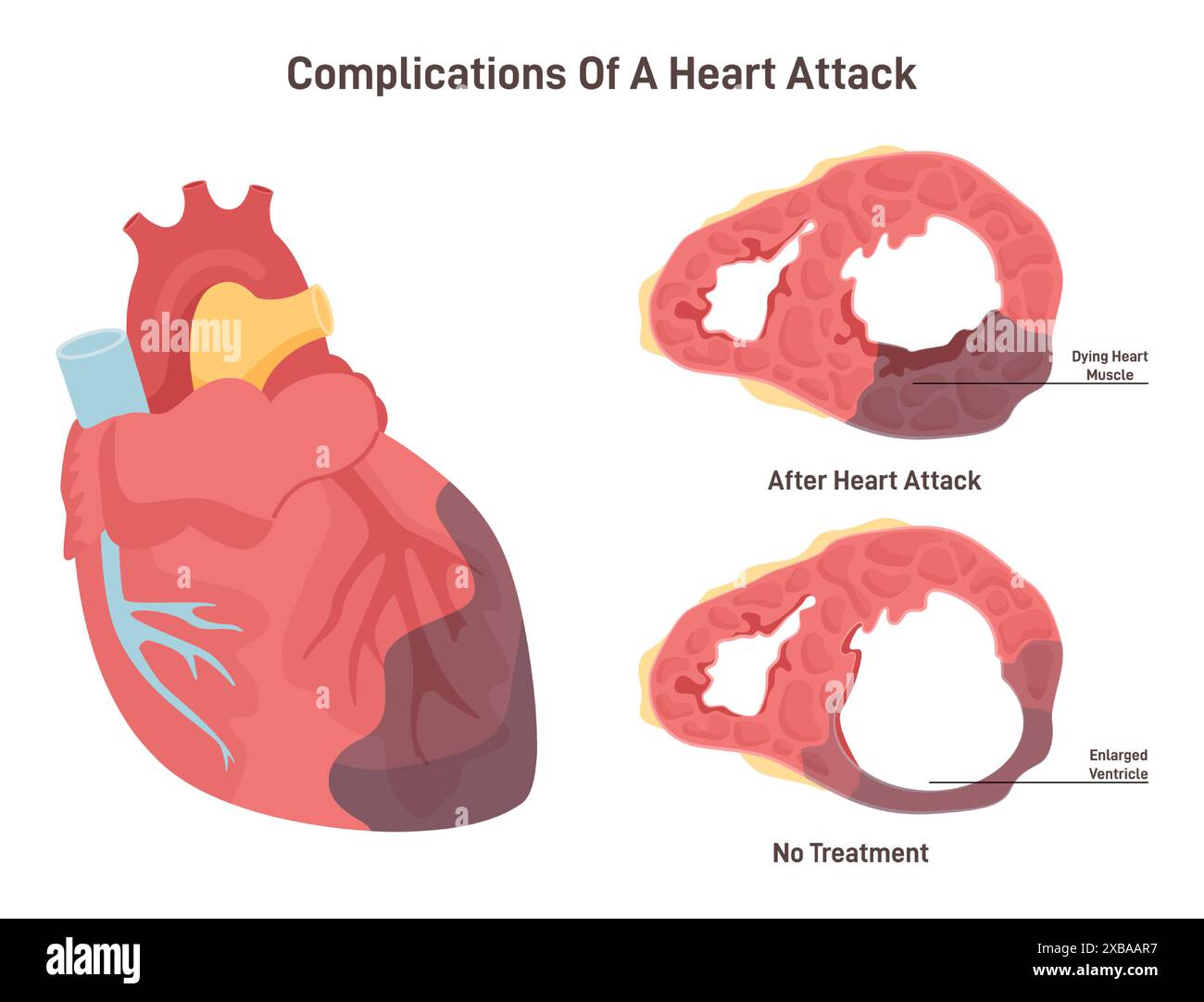 Heart attack complications. Heart wall thinning and ventricle ...