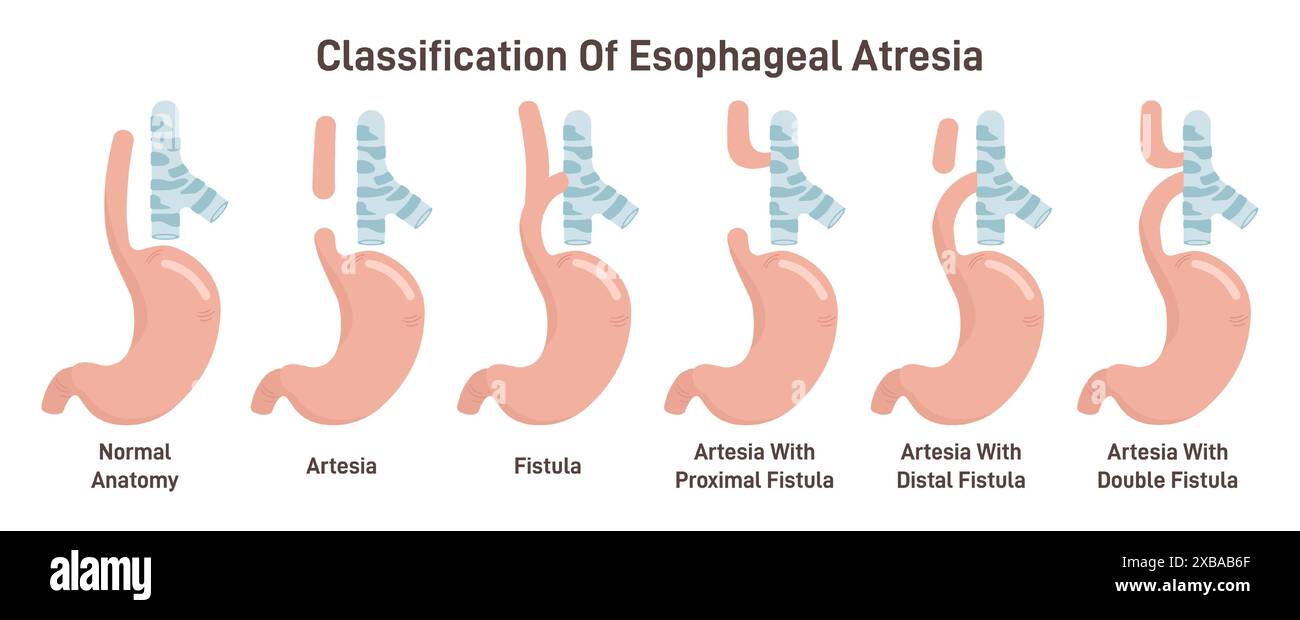 Esophageal atresia types set. Congenital medical condition of trachea ...