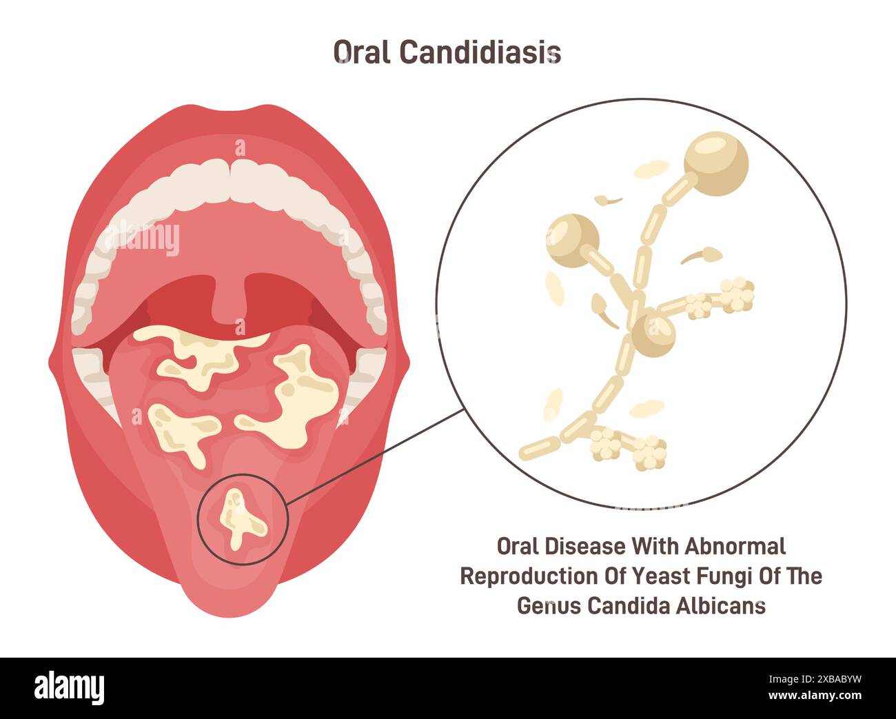 Oral Candidiasis Oral Yeast Infection Of Fungal Candida Albicans On The Mucous Membranes Of The