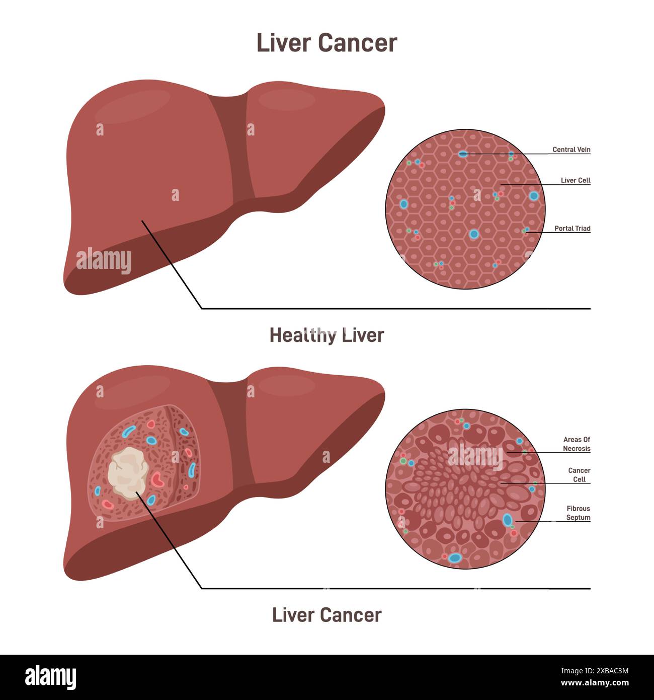 Liver cancer. Comparison between healthy organ and liver with carcinoma ...