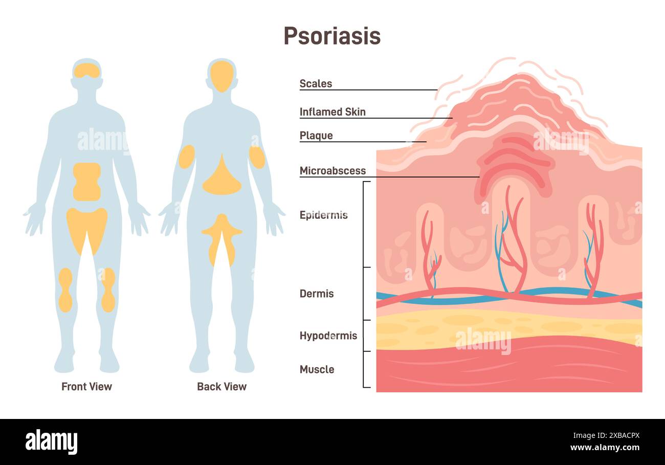 Psoriasis. Autoimmune disease characterized by areas of inflamed skin. Psoriasis plaque cross ...