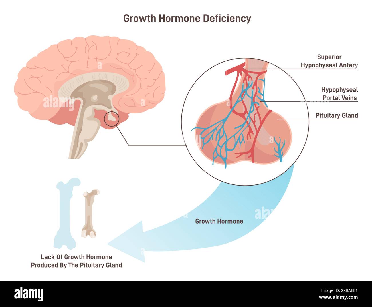 Growth hormone deficiency. Syndrome characterized by insufficient ...