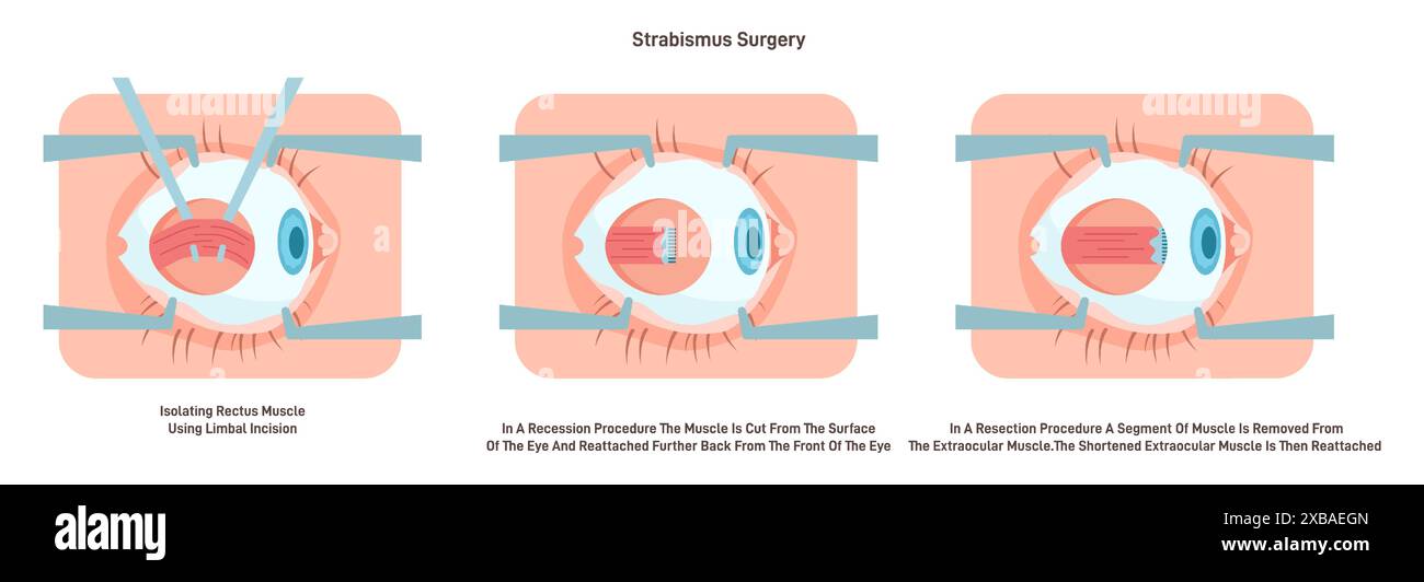 Strabismus surgery. Eye muscle recession, cutting the muscle from the surface of the eye and ...