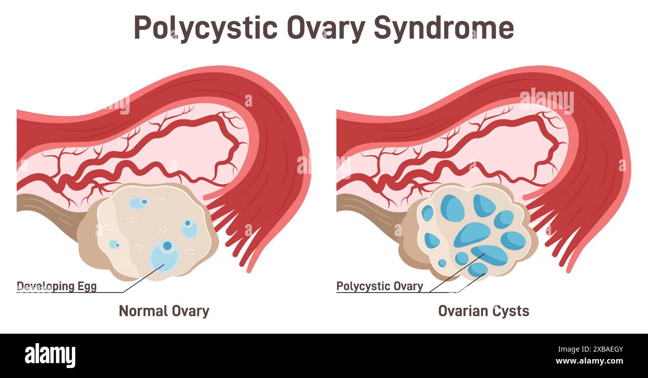 Polycystic ovary syndrome. PCOS hormonal disease. Female reproductive ...