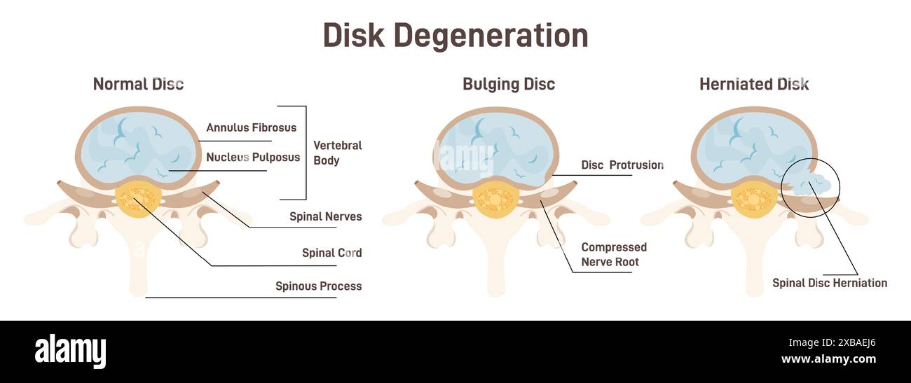 Disc degeneration stages set. flat Spine vertebrae anatomy scheme ...