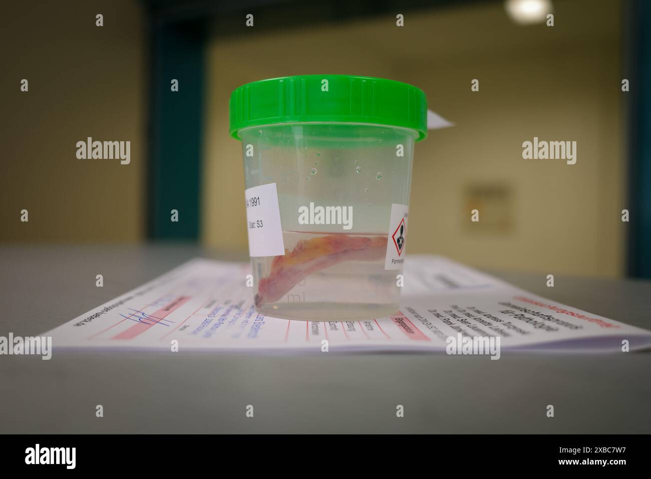 A removed appendix is placed in a dissecting dish filled with formalin ...