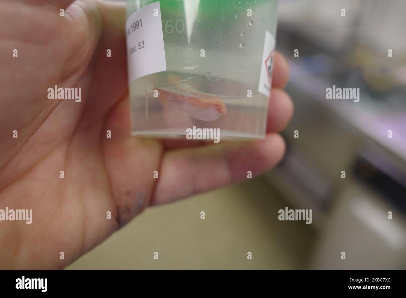 Appendicitis peritonitis colitis hi-res stock photography and images ...