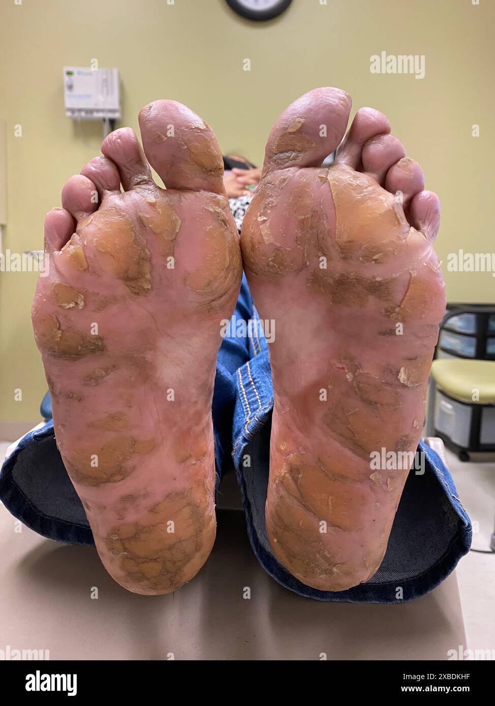 Palmoplantar psoriasis on the soles of the feet of 62 year old Hispanic ...