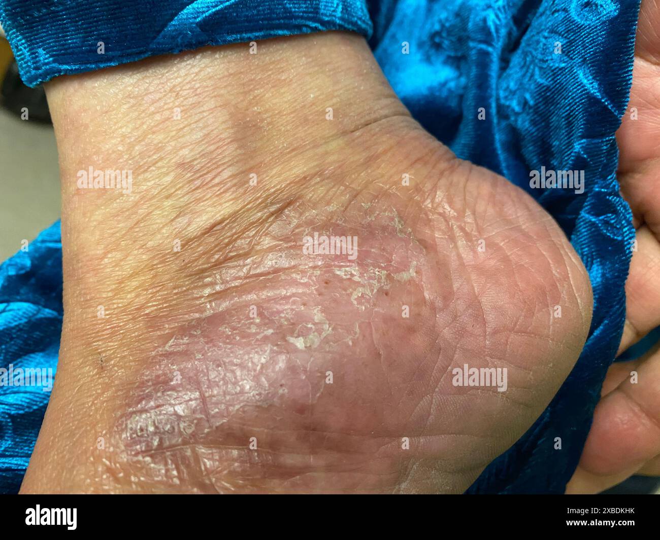 Palmoplantar psoriasis on a patient's foot. Psoriasis is a skin ...