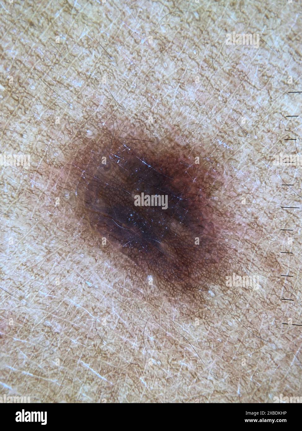 Dermatoscope image of a dermatofibroma on the skin of a 34 year old ...
