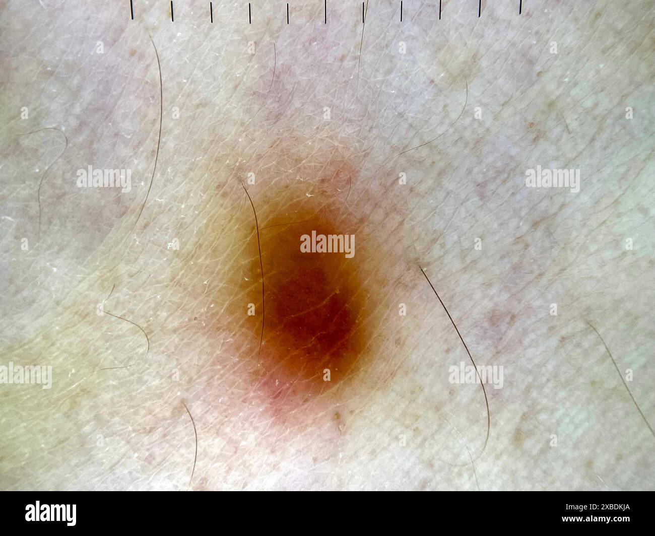 Dermatoscope image of a dermatofibroma on the skin of a 33 year old ...