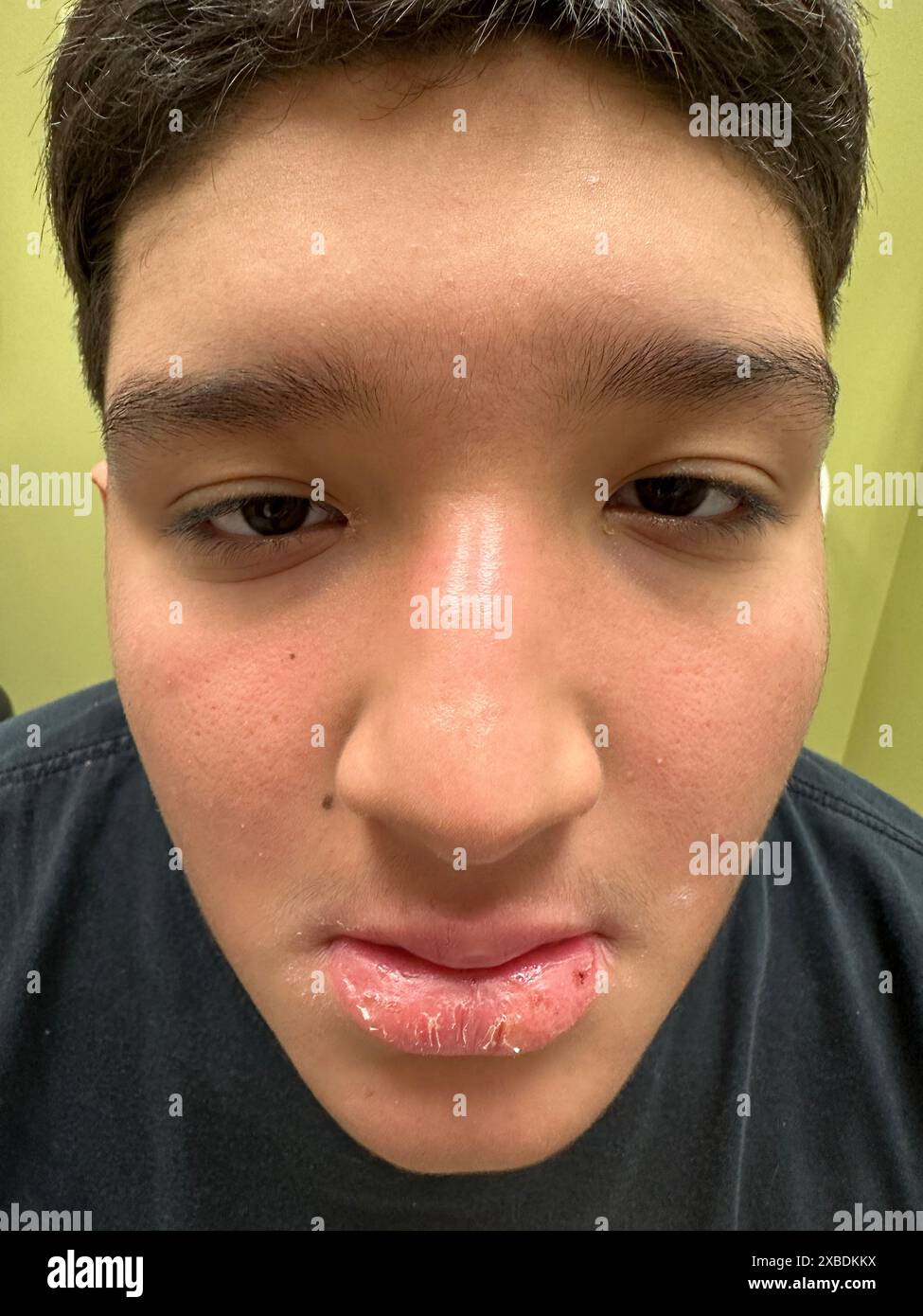 Face of a 12 year old Hispanic male patient whose acne has cleared ...