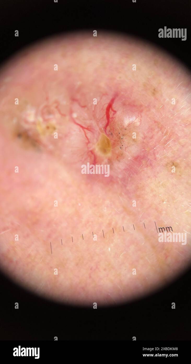 Dermatoscope image of a nodular basal cell carcinoma (BCC), or rodent ...