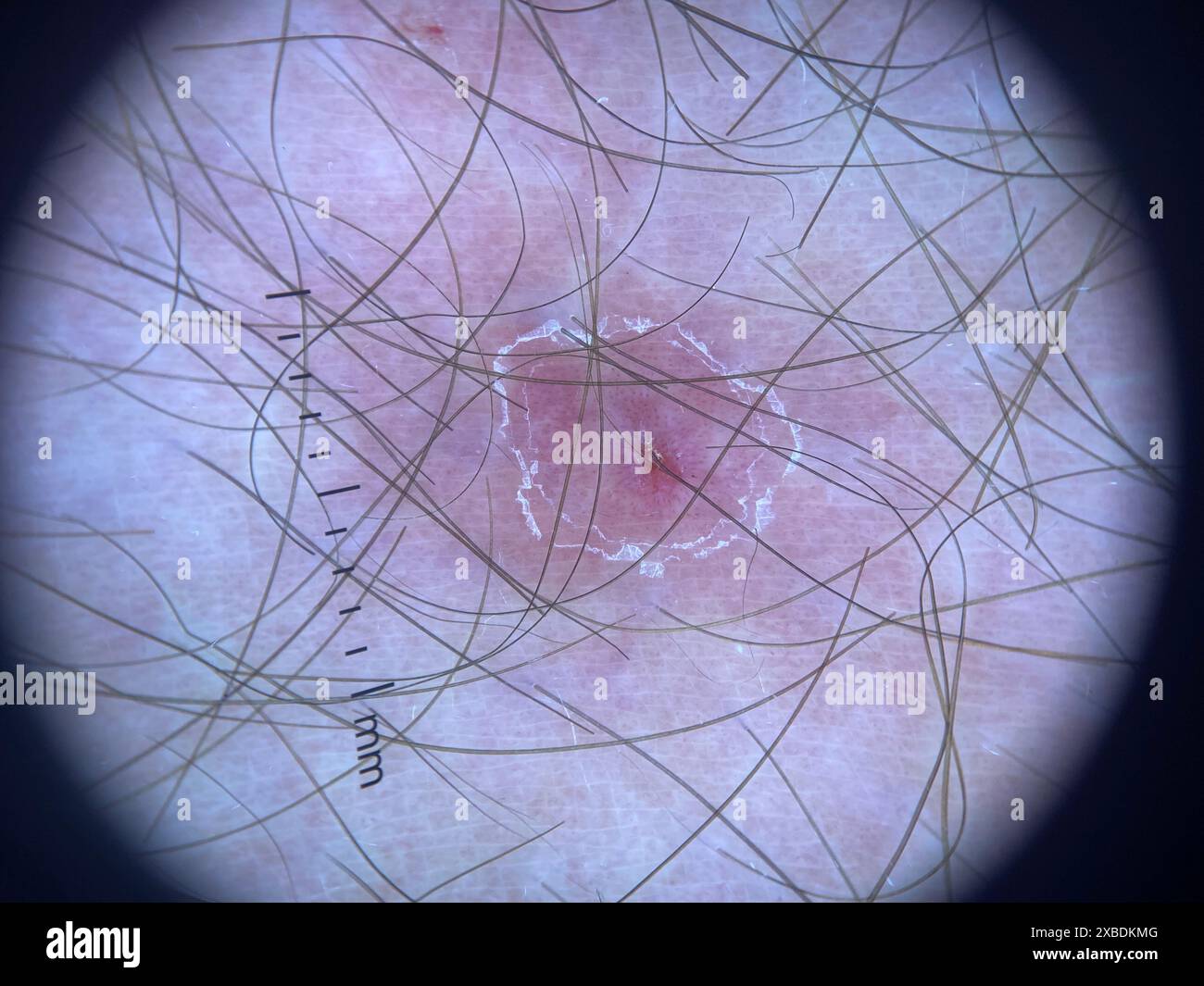 Dermatoscope image of of an eosinophilic folliculitis lesion on the leg ...