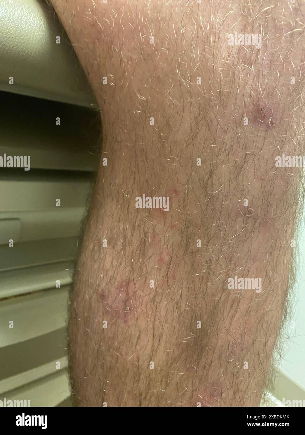 Eosinophilic folliculitis lesion on the leg of a male patient who is ...