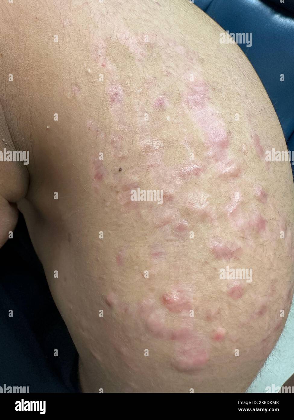 Skin of a 12 year old Hispanic male patient whose acne has cleared ...