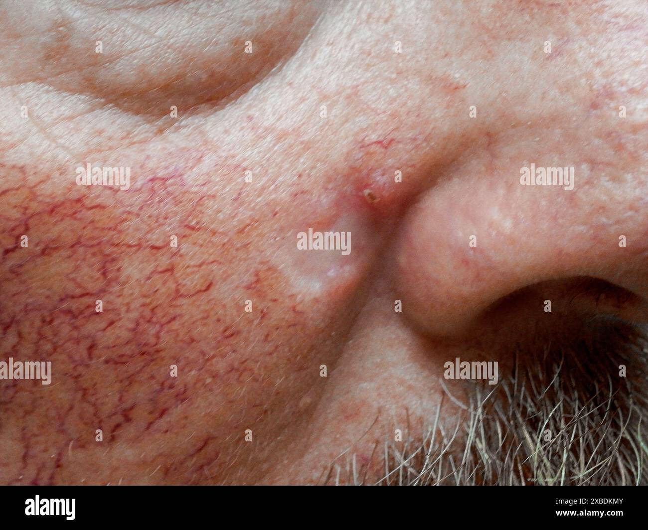 Nodular basal cell carcinoma (BCC), or rodent ulcer, on a 70 year old ...