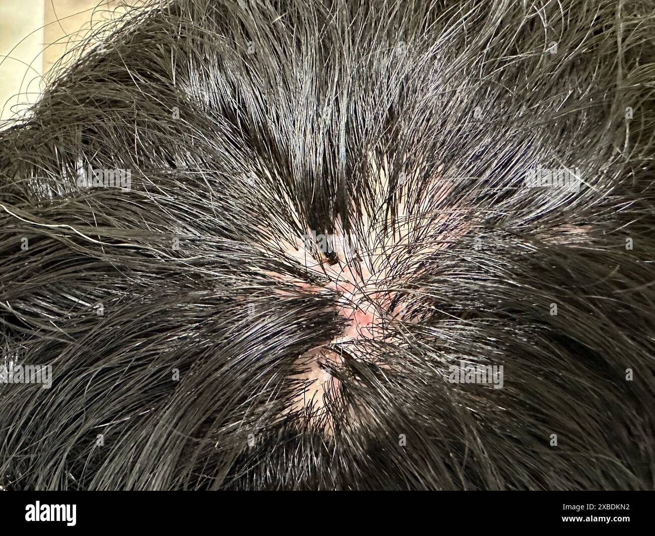 Scalp of a 35 year old Hispanic female patient with hair loss caused by ...