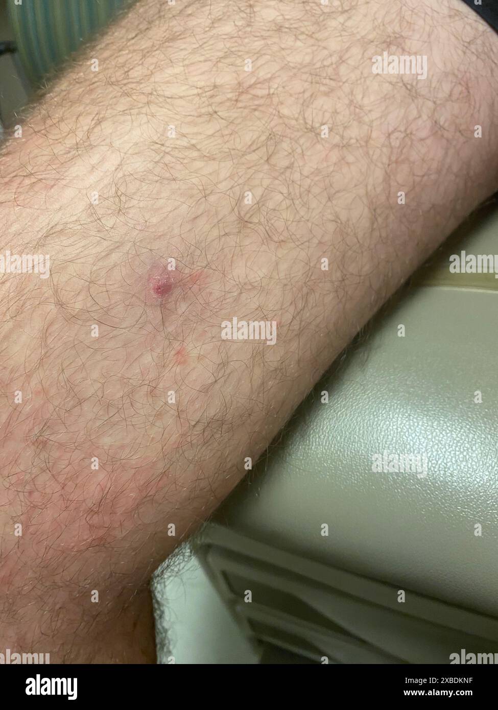 Eosinophilic folliculitis lesion on the leg of a male patient who is ...