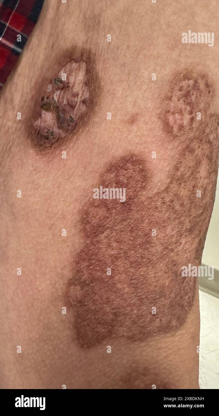 Healing pyoderma gangrenosum lesions on the skin of a patient who is being treated with ...