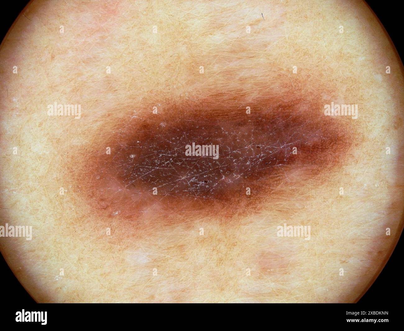 Dermatoscope image of a dermatofibroma on the skin of a 40 year old ...