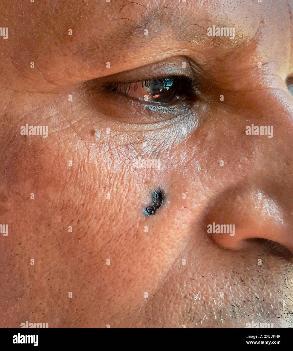 Basal cell carcinoma (BCC), or rodent ulcer, on a patient's cheek. This ...