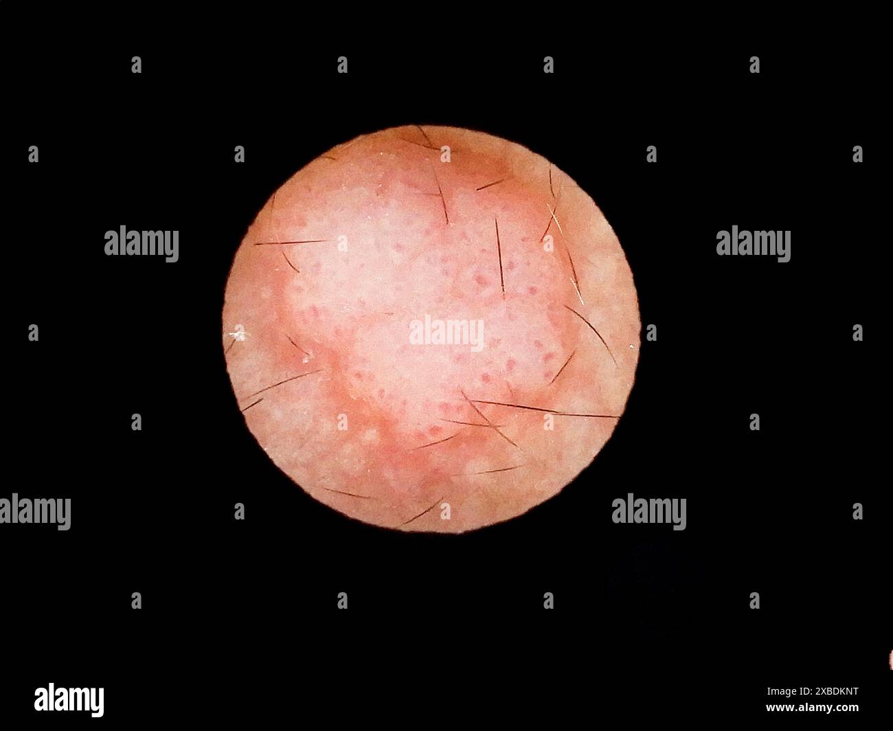 Dermatoscope image of a wart on a Hispanic female patient's skin. Warts ...