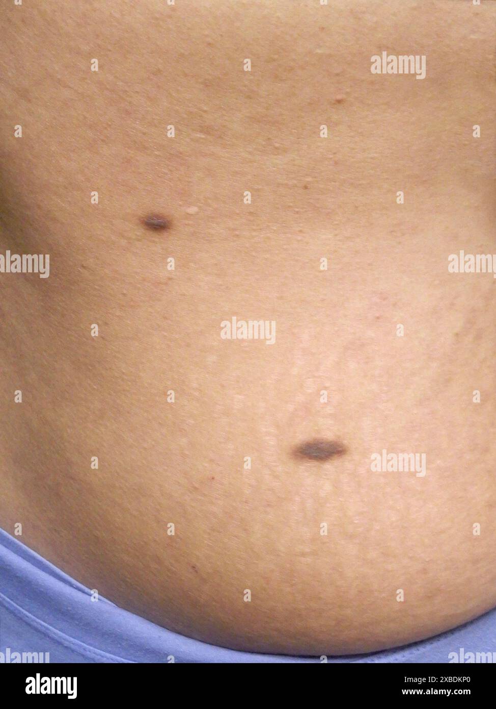 Dermatofibromas on the abdomen of a 40 year old female South Asian ...